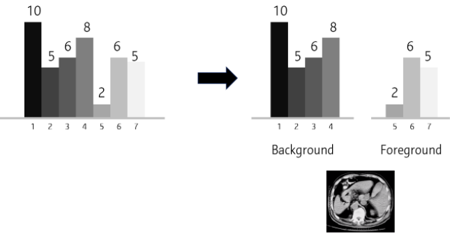 Medical Image Segmentation - Otsu thresholding